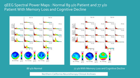How to interpret qEEG results? | NeuroTraining Strategies