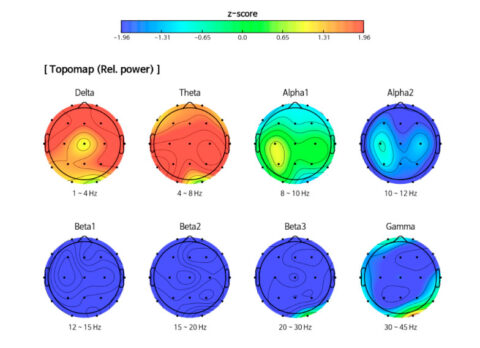 How to interpret qEEG results? | NeuroTraining Strategies